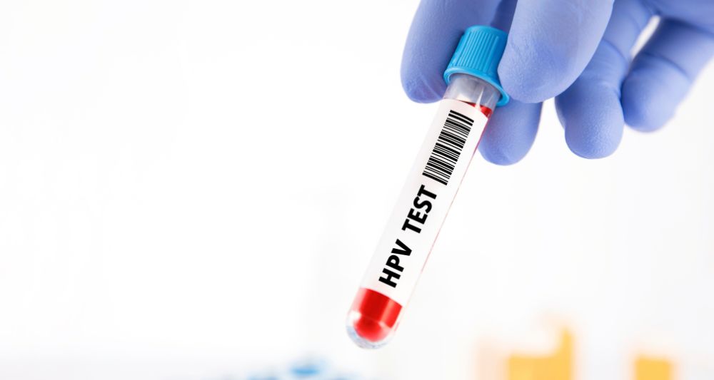 Descubre cómo se contrae el virus del papiloma humano y cómo detectarlo ...